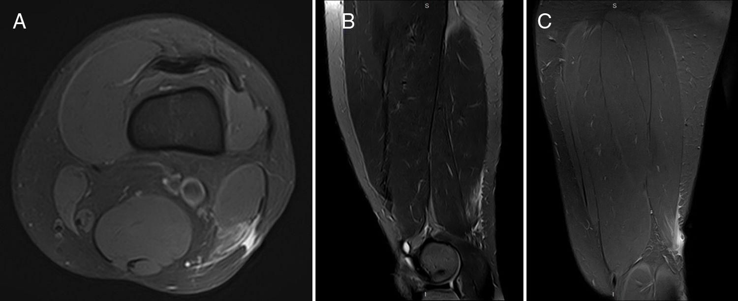 The MLG-R muscle injury classification for hamstrings. Examples and ...