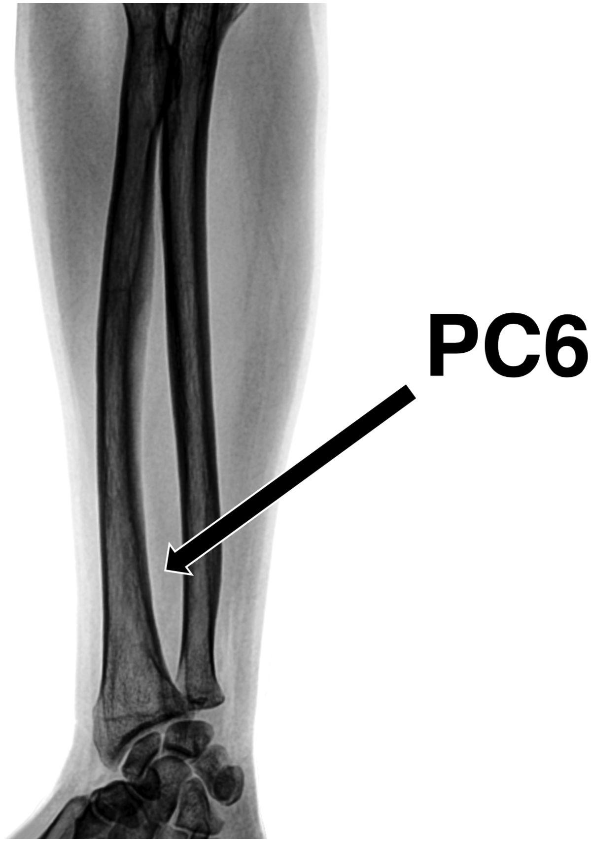 Effect of acupuncture in Pericardium 6 (Neiguan) acupoint in the acute ...