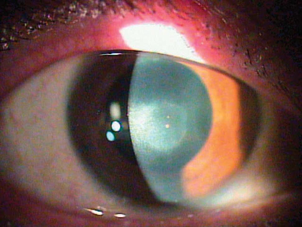 Retinal Straylight Before and After Penetrating Keratoplasty in an Eye ...