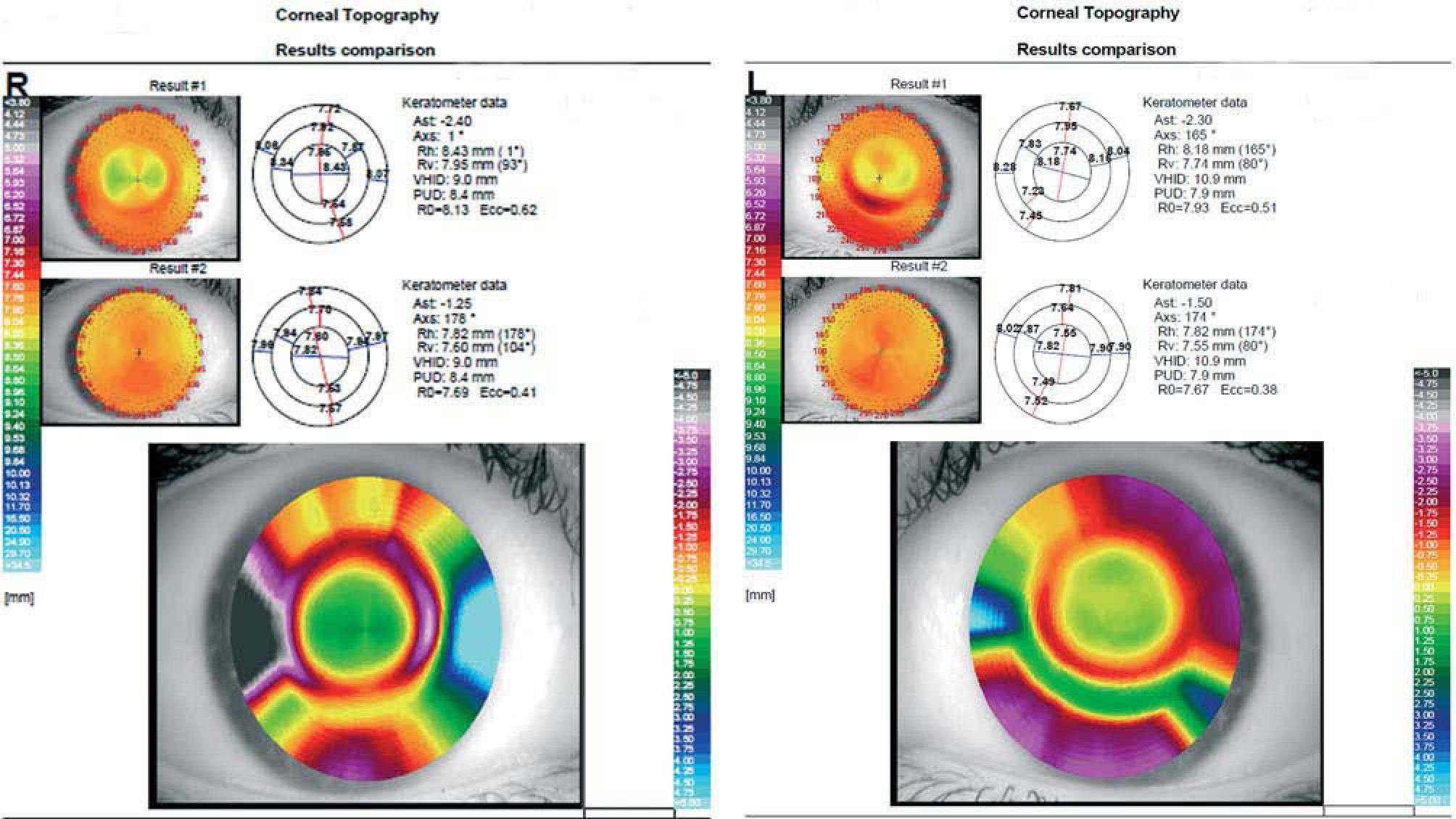 Contact lens intolerance: refitting with dual axis lens for corneal ...