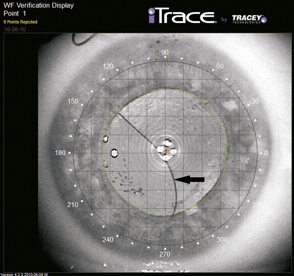 Follow up of intraocular lens subluxation with a combined topographer ...