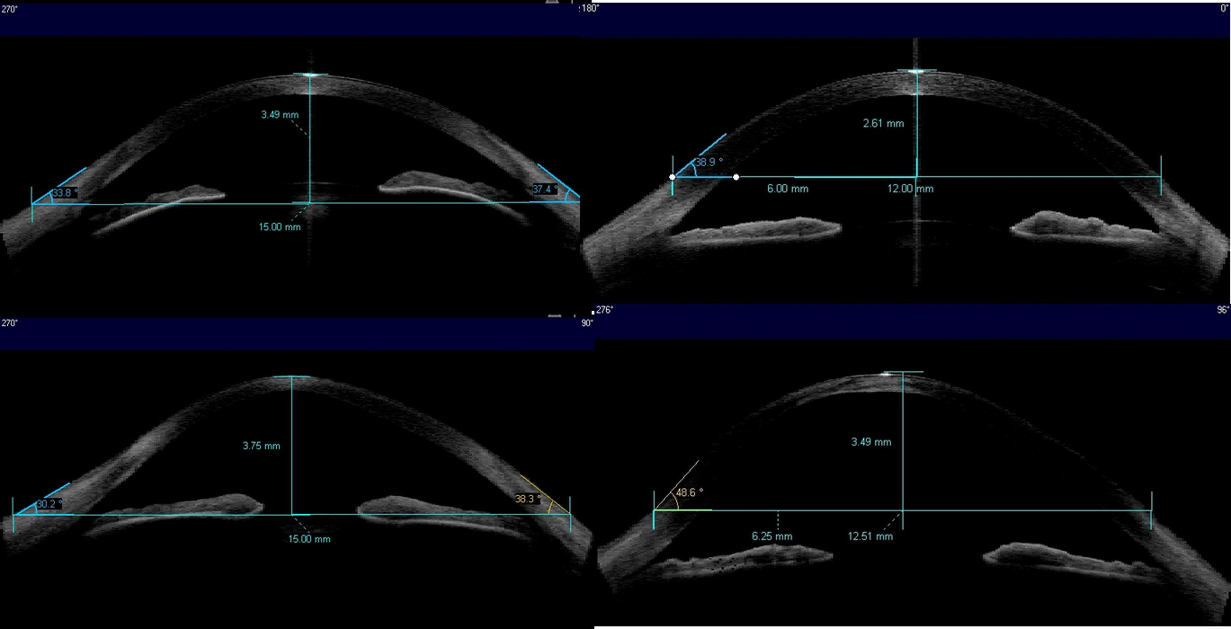 Use of the Visante™ OCT to measure the sagittal depth and scleral shape ...