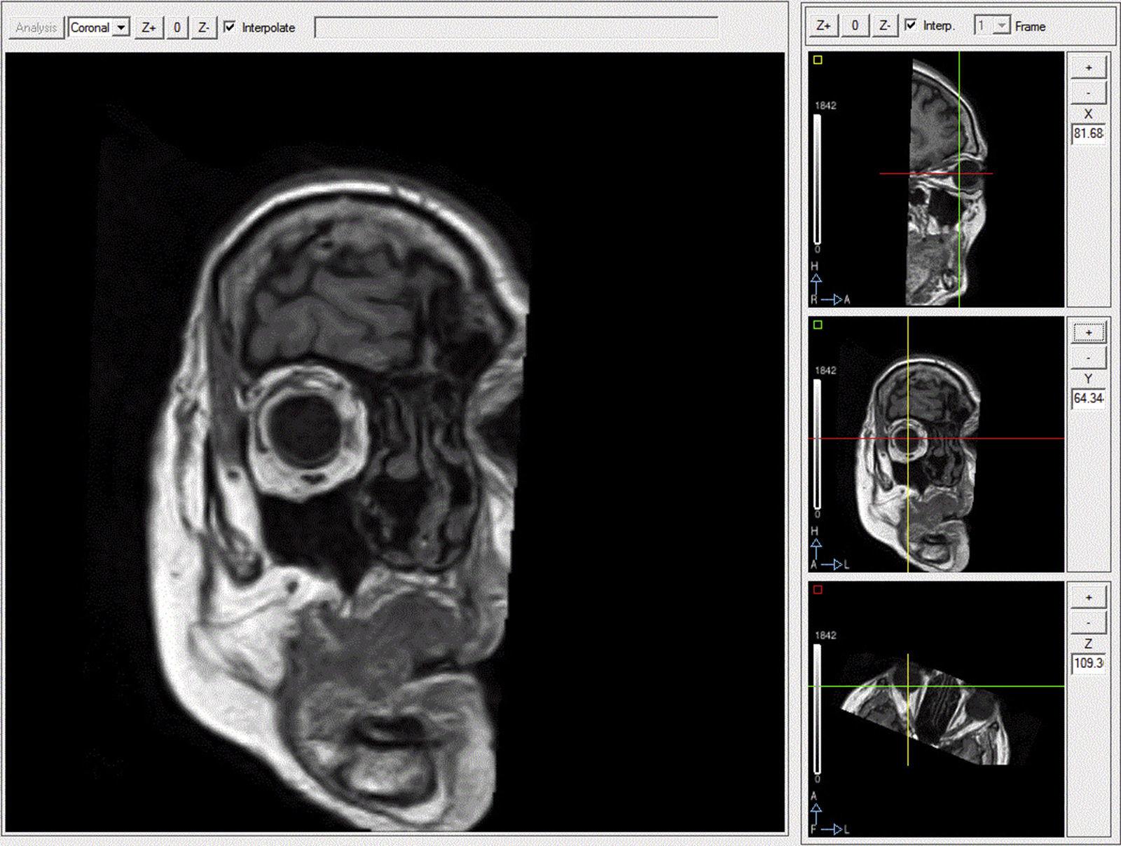Orbital magnetic resonance imaging is useful in age-related distance ...