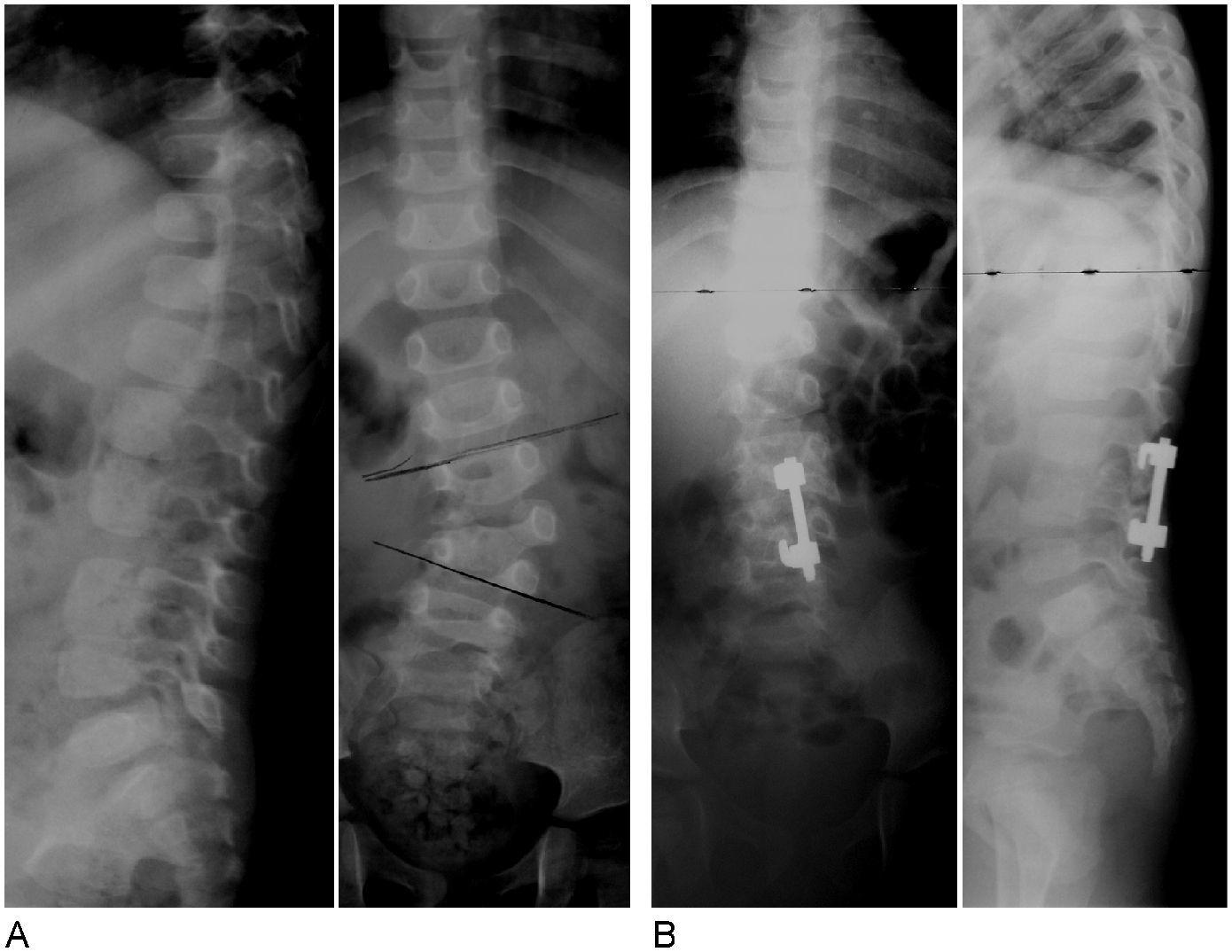 Tratamiento quirúrgico de la escoliosis congénita por hemivértebra ...