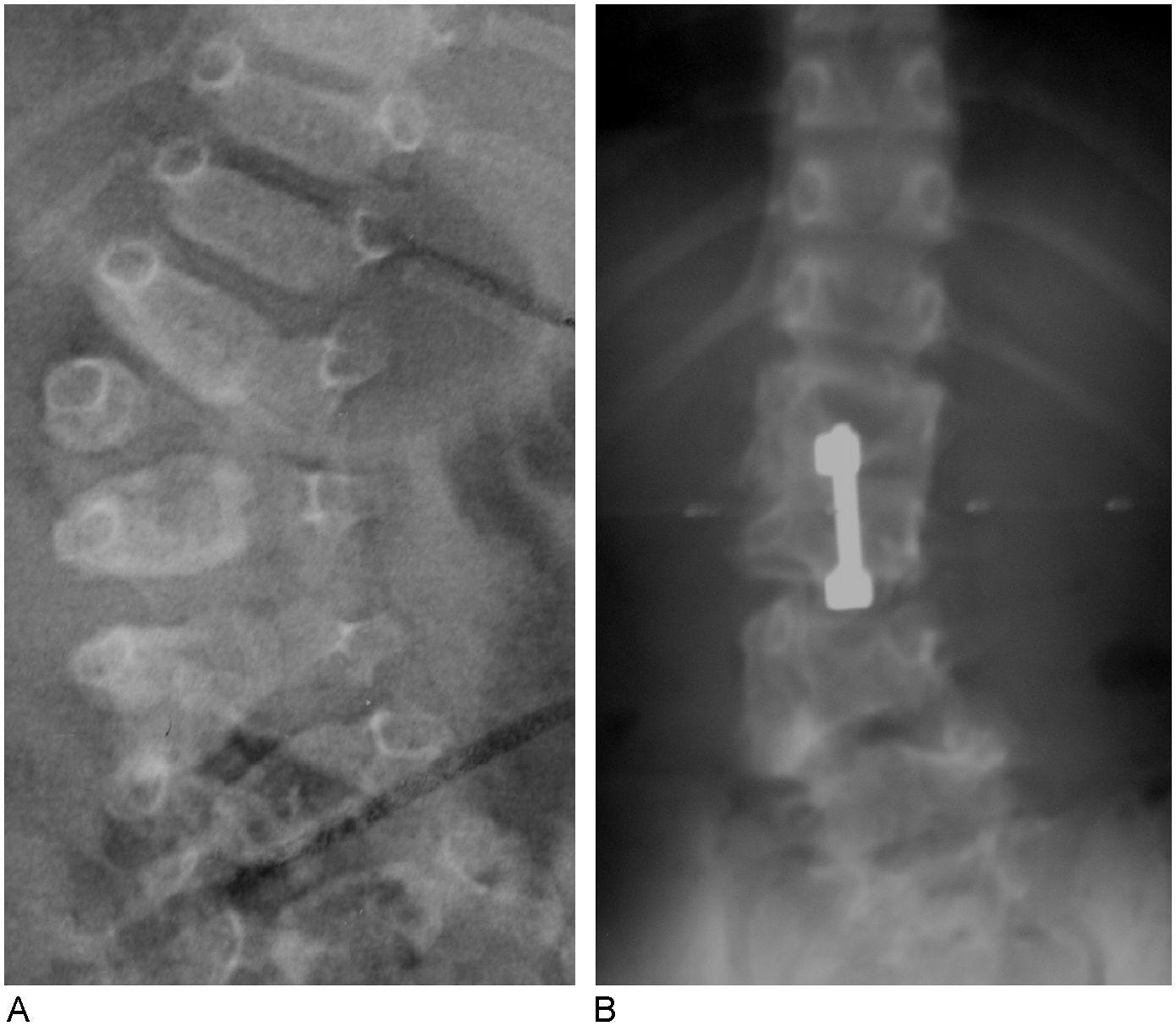 Tratamiento quirúrgico de la escoliosis congénita por hemivértebra ...