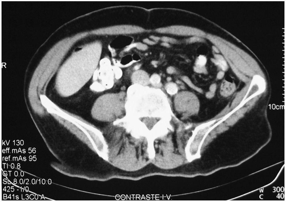 Absceso retroperitoneal gigante secundario a infección protésica de ...