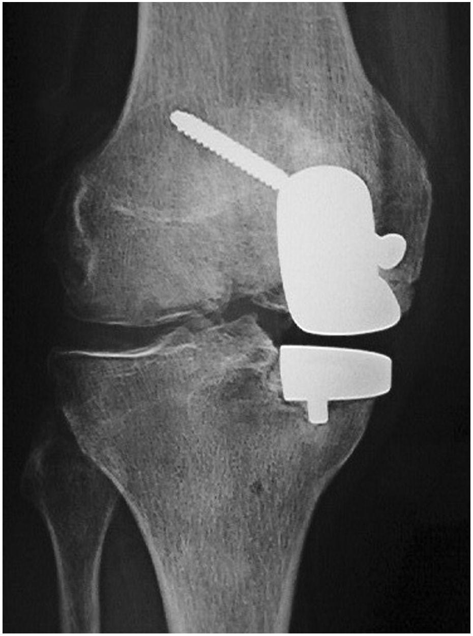 Valoración clínica y radiológica de las prótesis unicompartimentales de ...