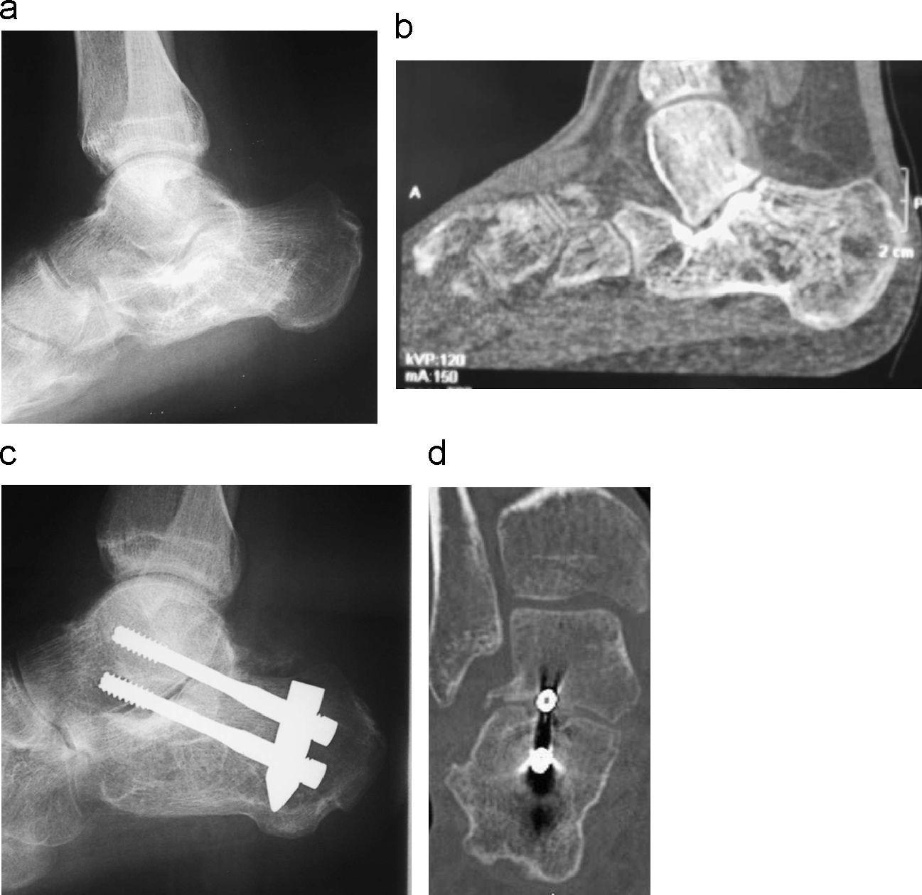 Artrodesis subastragalina secundaria mediante el sistema Vira® en el ...