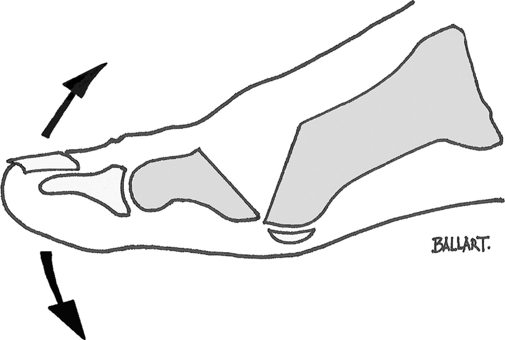 Hallux rígidus: etiología, diagnóstico, clasificación y tratamiento ...