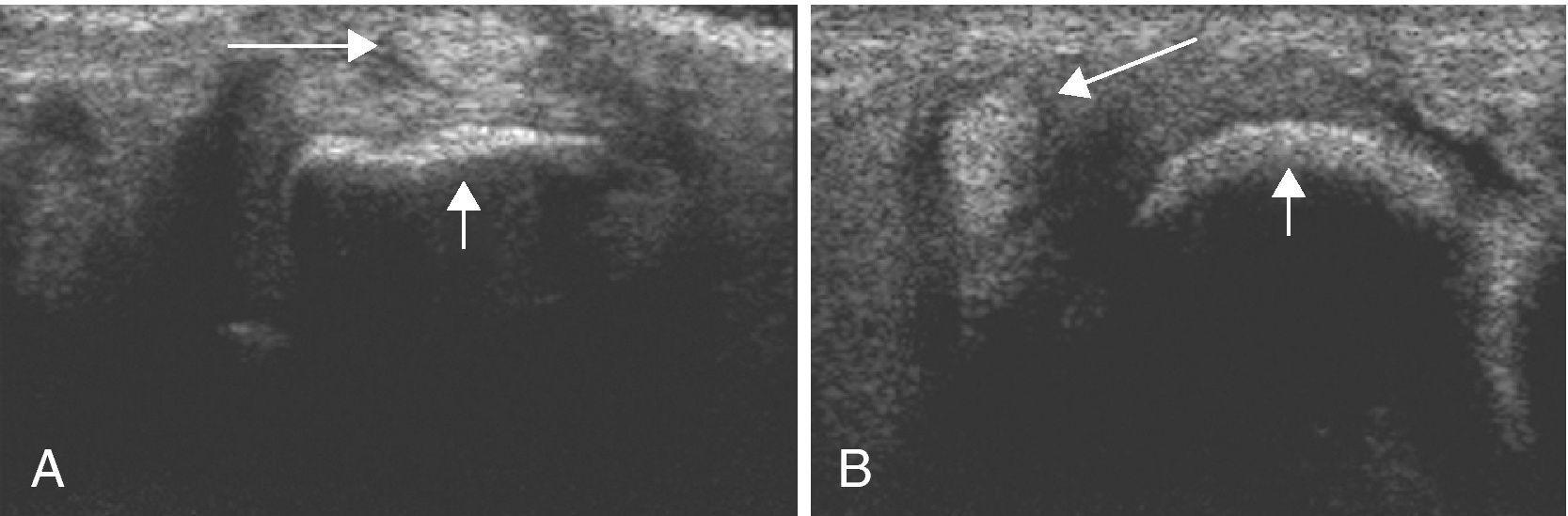 Luxación de los tendones extensores de la mano a nivel de la ...