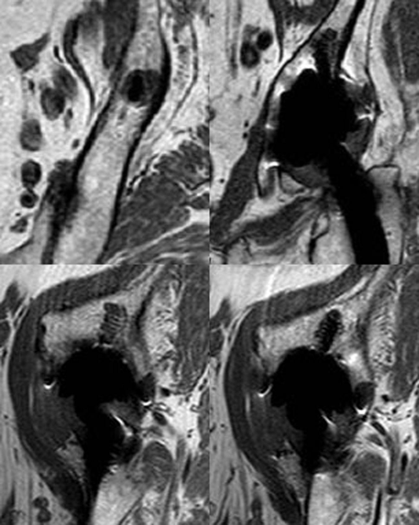 Distribución de la osteólisis periprotésica en la cadera. Estudio con ...