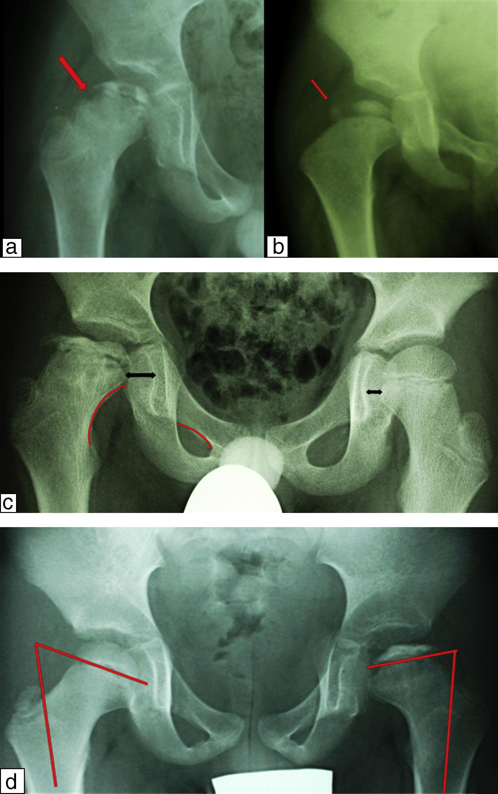 Enfermedad de Legg-Calvé-Perthes | Revista Española de Cirugía ...
