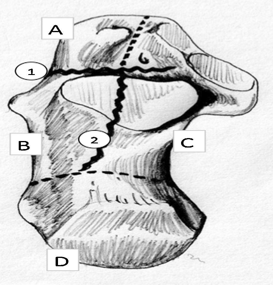Manejo actual de las fracturas intraarticulares del calcáneo | Revista ...