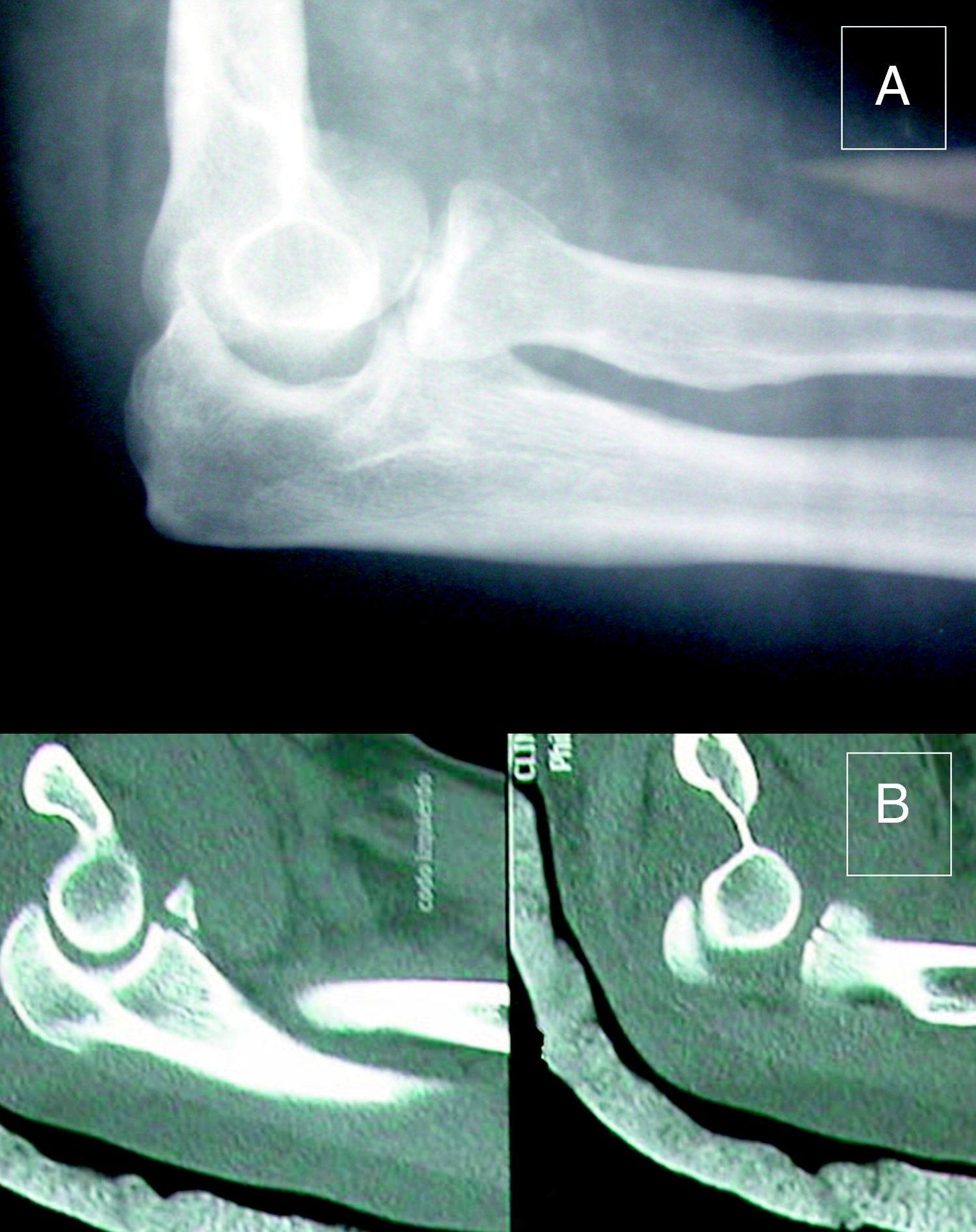 Luxación bilateral de codo asociada a lesión de Essex-Lopresti ...