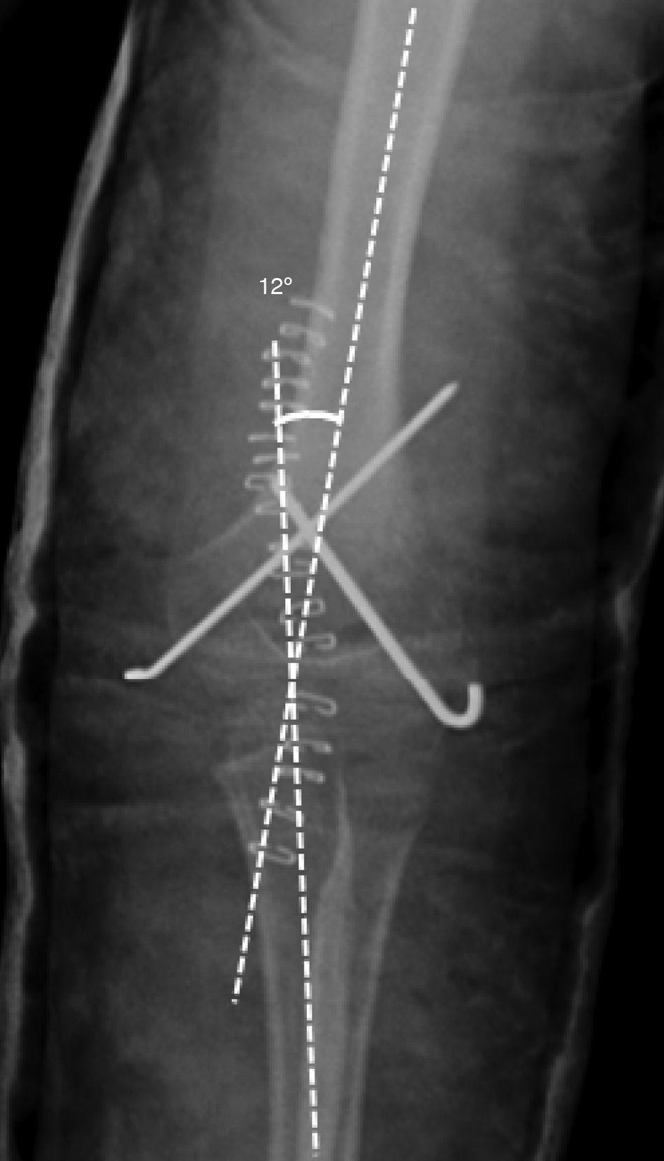 Revisión de los resultados a los 10 años del tratamiento quirúrgico de ...