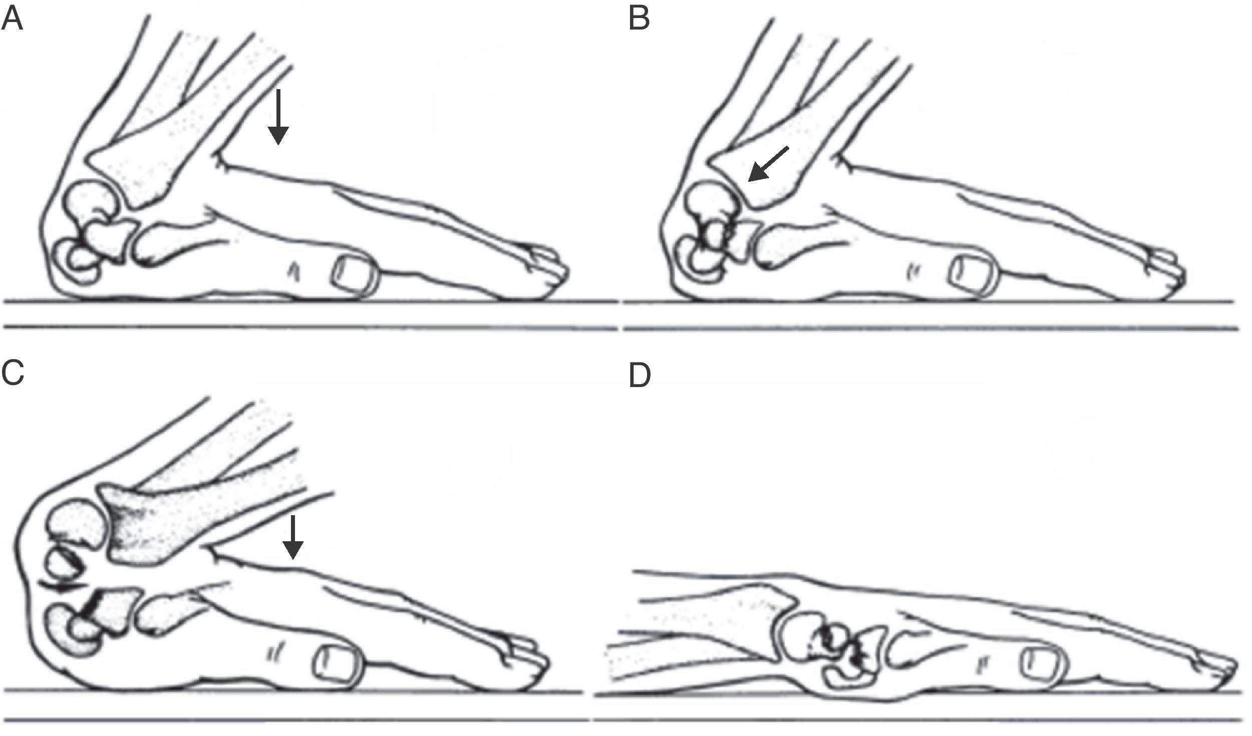 Síndrome de Fenton | Revista Española de Cirugía Ortopédica y Traumatología
