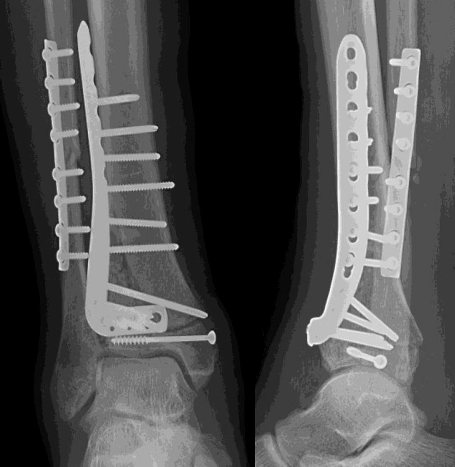 Placas mediales versus laterales para las fracturas de pilón tibial: estudio prospectivo de 40 ...