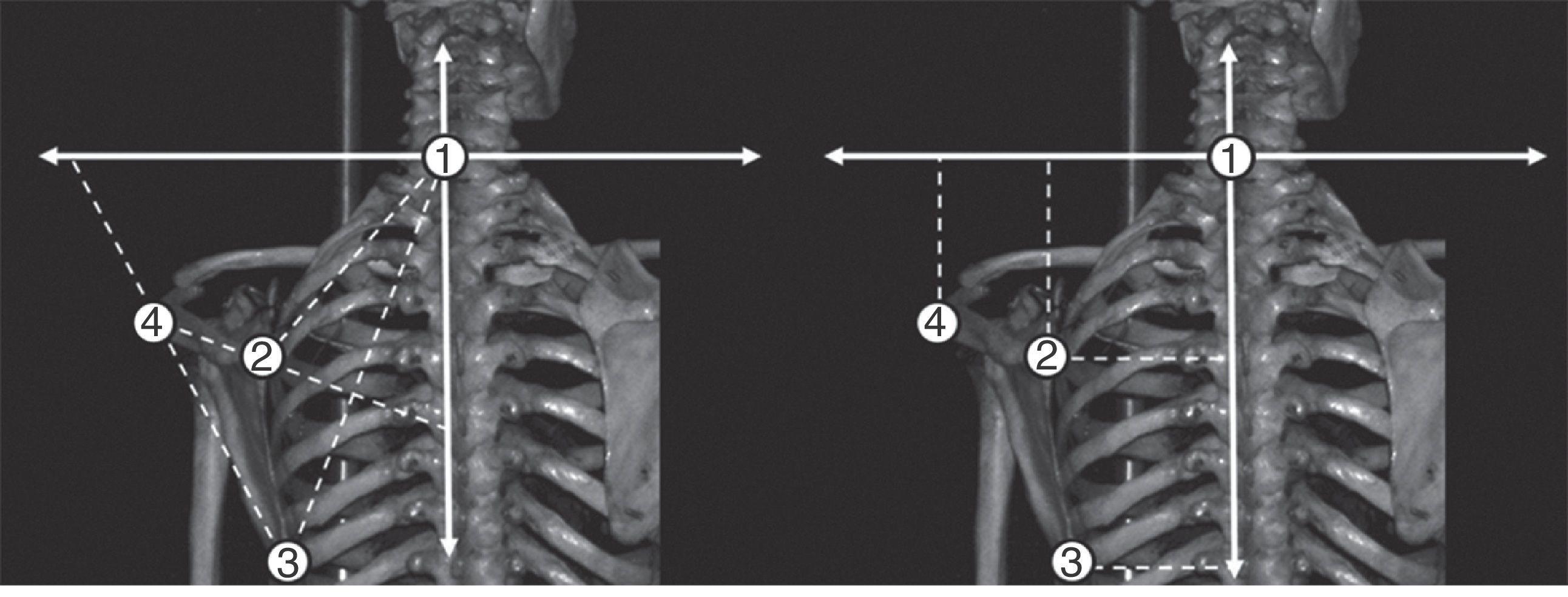 Valores de referencia del ángulo de balance escapular en población sana ...