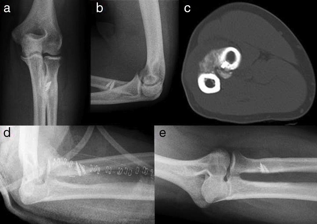 Tratamiento de la sinostosis radiocubital proximal mediante la ...