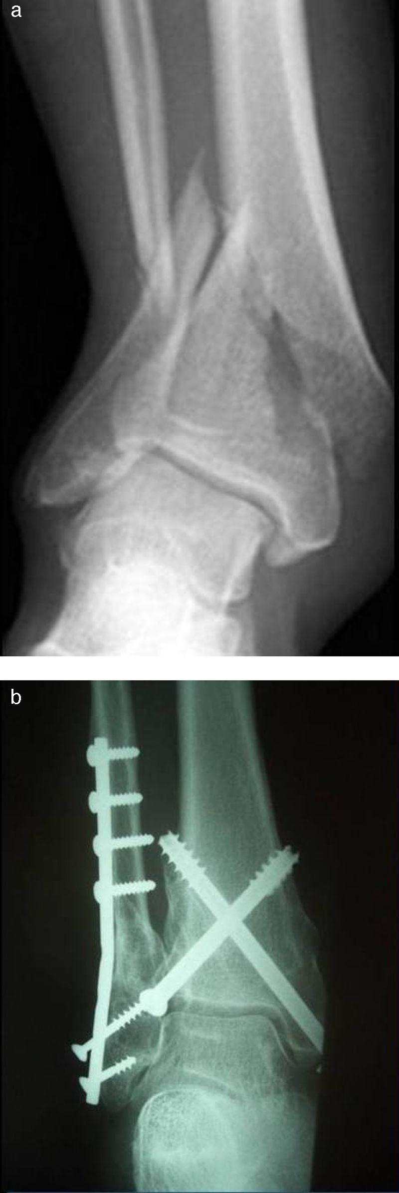 Osteosíntesis percutánea en fracturas de pilón tibial, ¿condiciona la ...