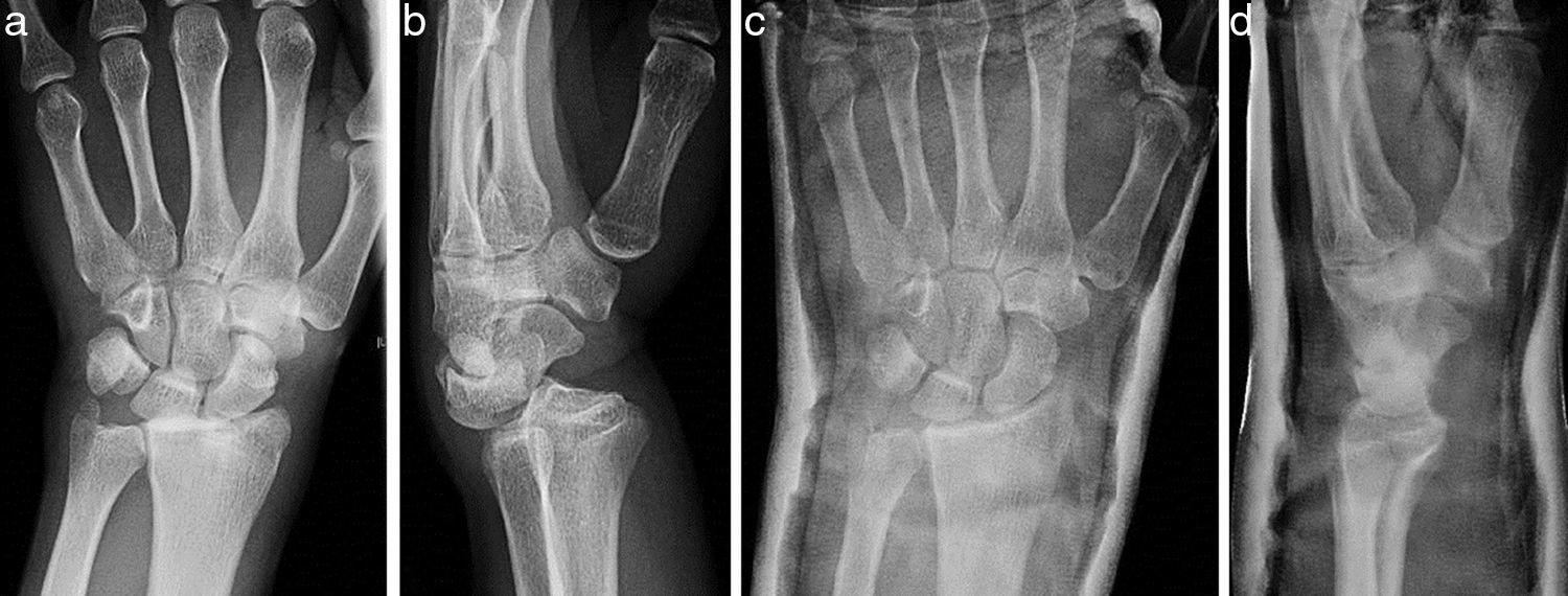 Luxación radiocarpiana tras traumatismo banal | Revista Española de ...