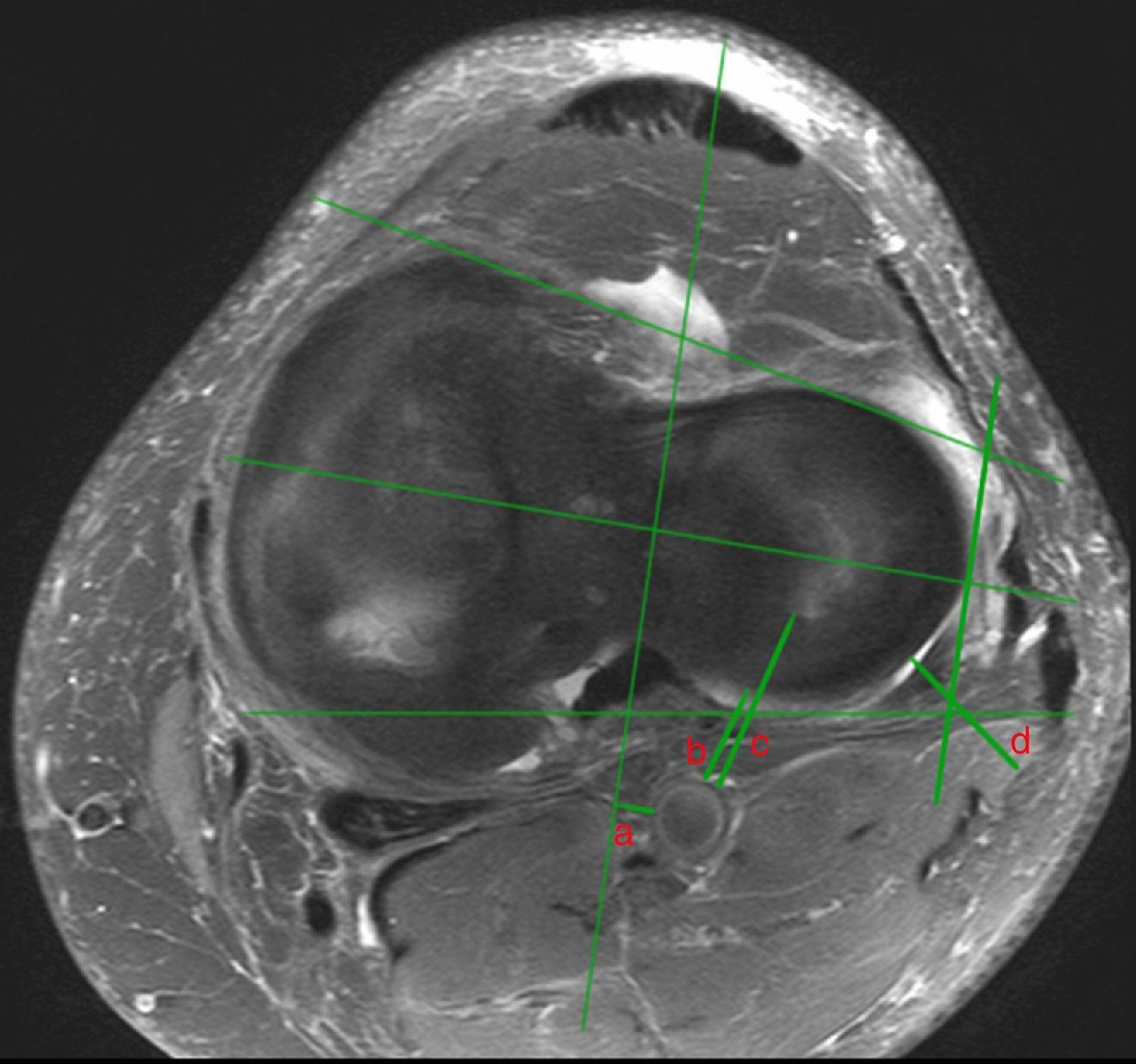 Localización de la arteria poplítea y su relación con el riesgo ...