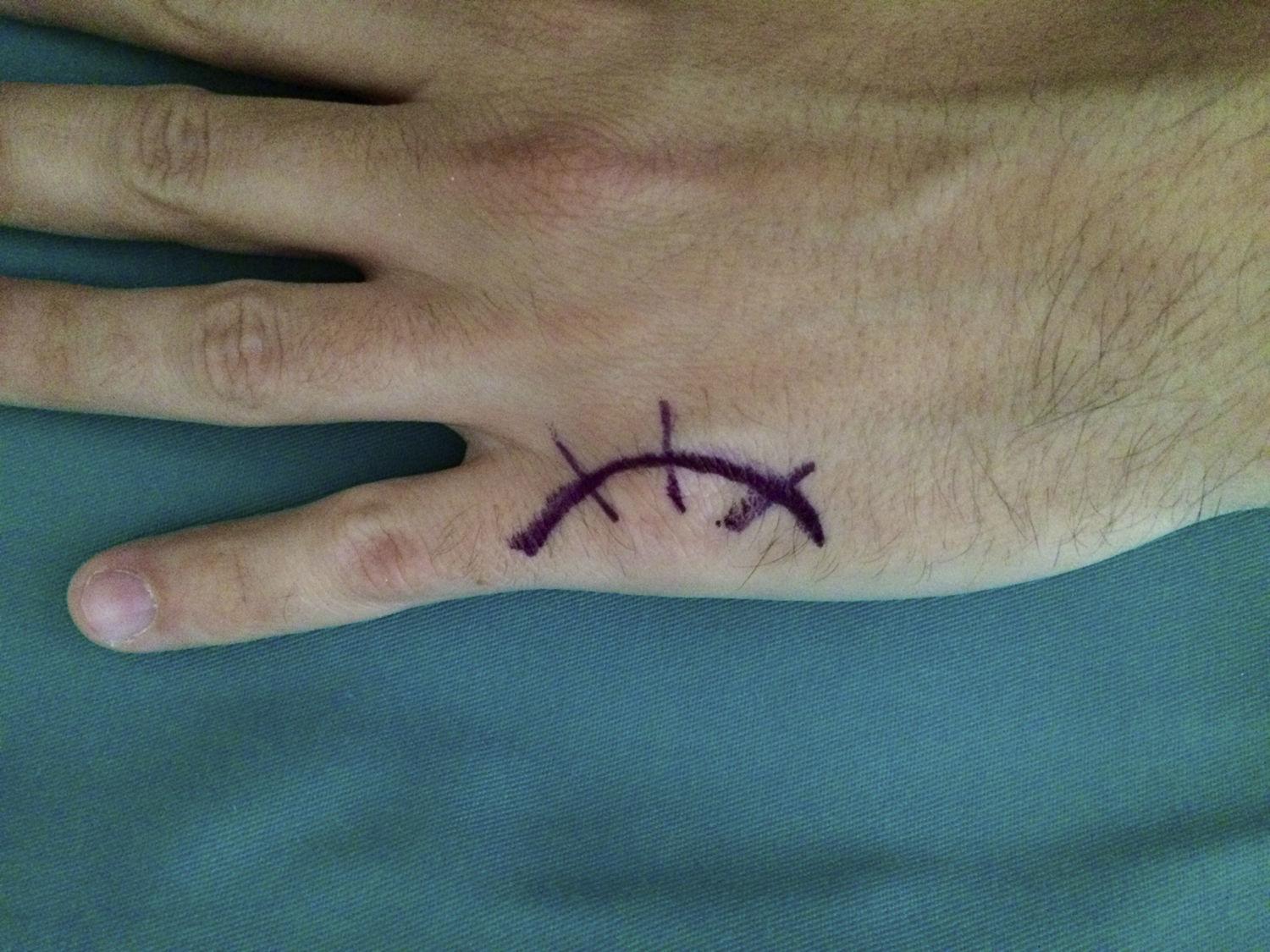 Rigideces metacarpofalángicas en extensión. ¿Un desafío para el ...