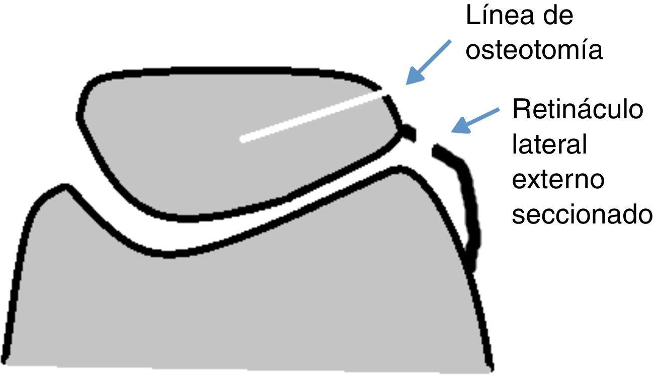 La osteotomía patelar coronal de la faceta externa asociada a ...