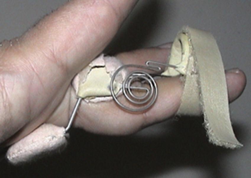 Rehabilitación domiciliaria en el tratamiento postoperatorio de la ...