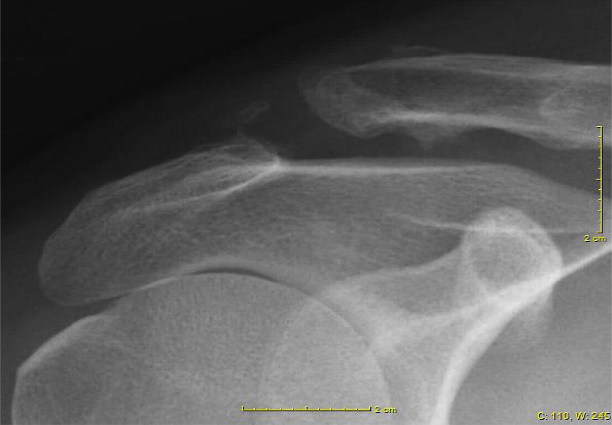 Resultados del tratamiento quirúrgico de las luxaciones ...