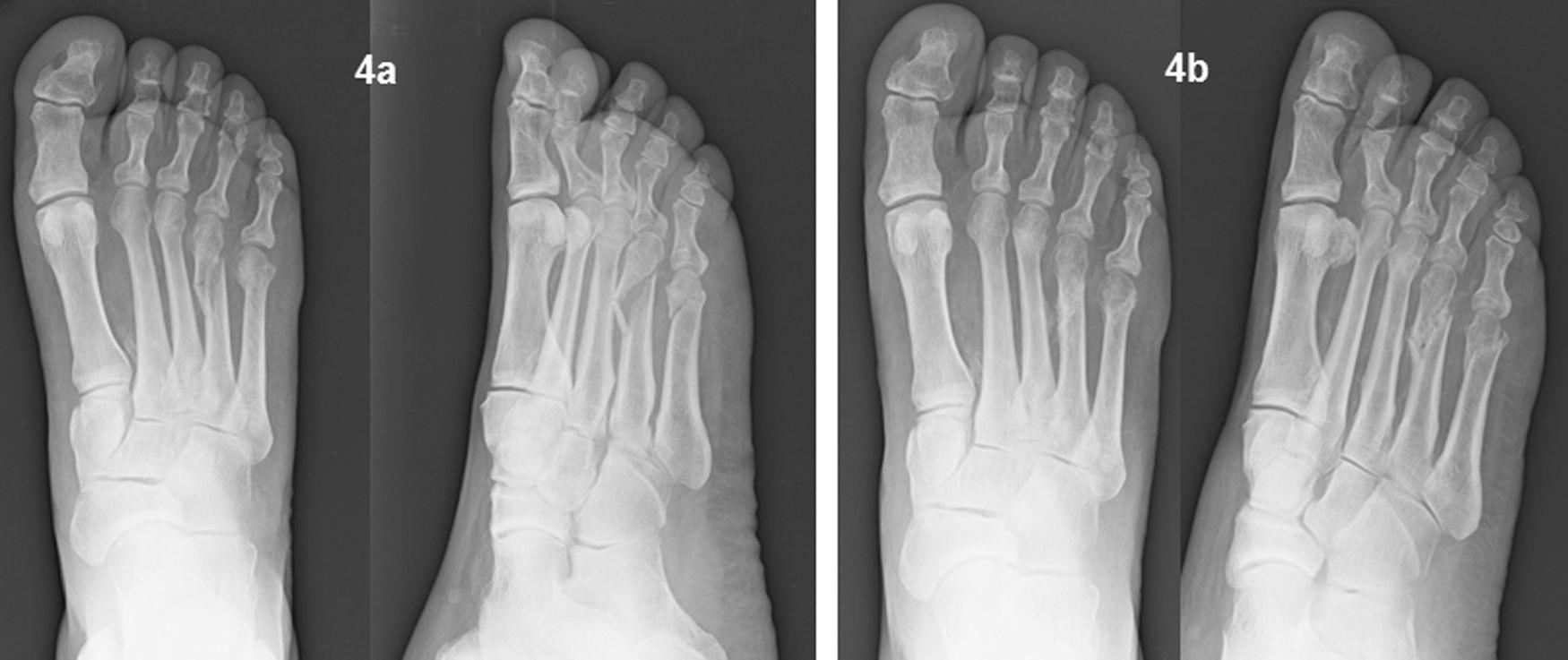 El apoyo inicial sin inmovilización como terapia de elección en las ...