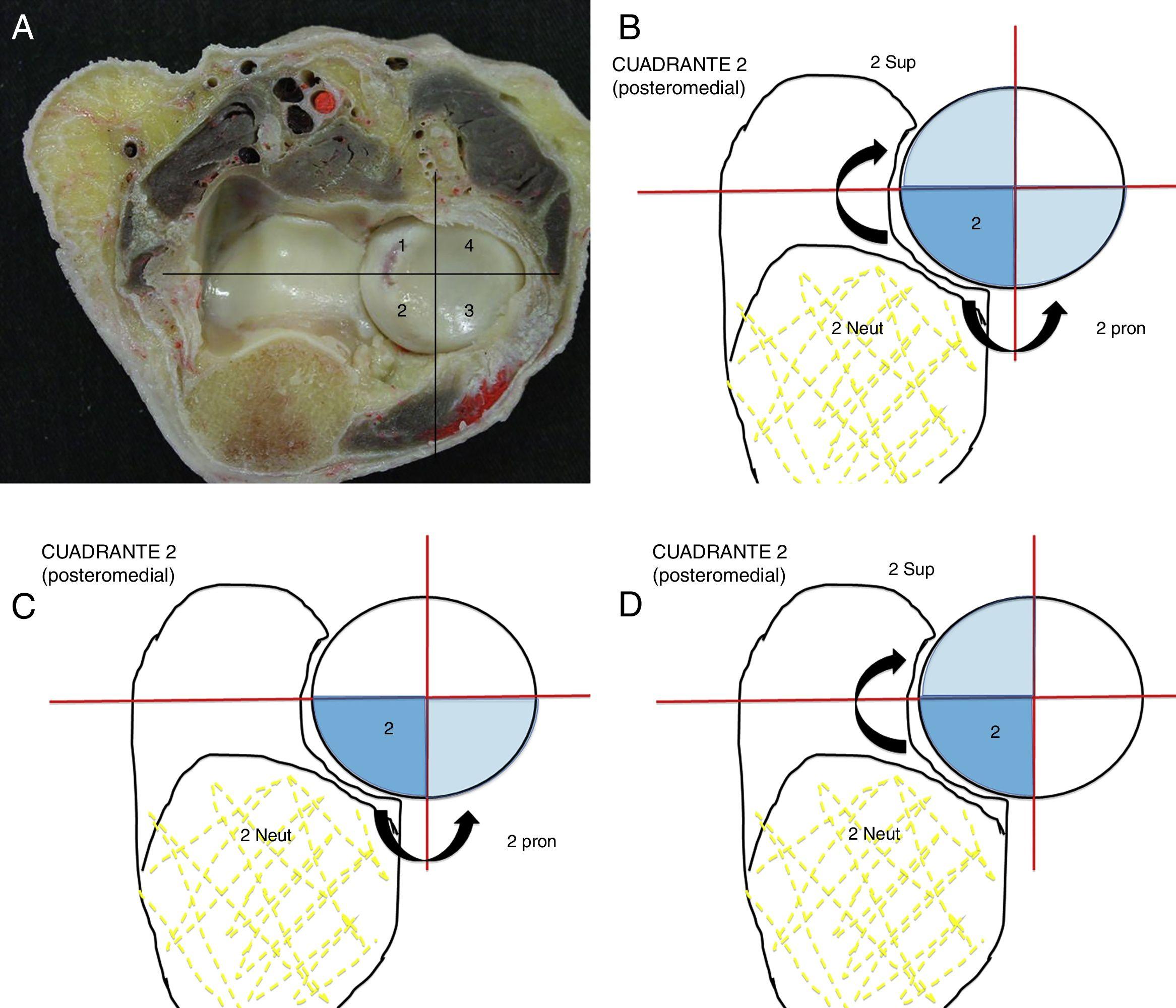 Clasificación del patrón transversal de las fracturas de la cabeza del ...