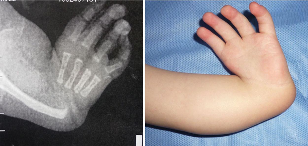 Deficiencia radial longitudinal. Análisis de resultados clínicos y ...