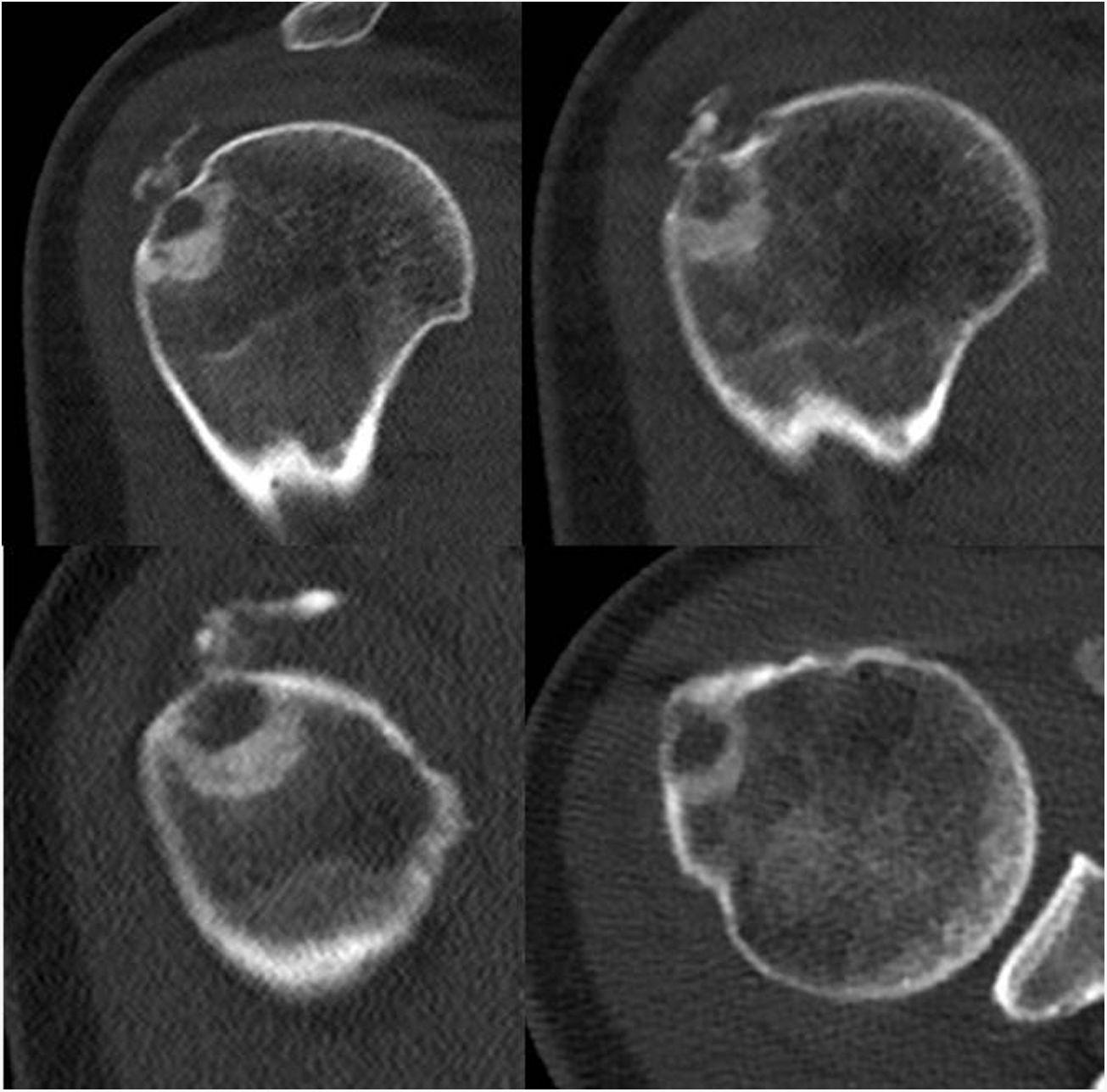 Tendinitis calcificante de hombro con extensión intraósea: experiencia ...
