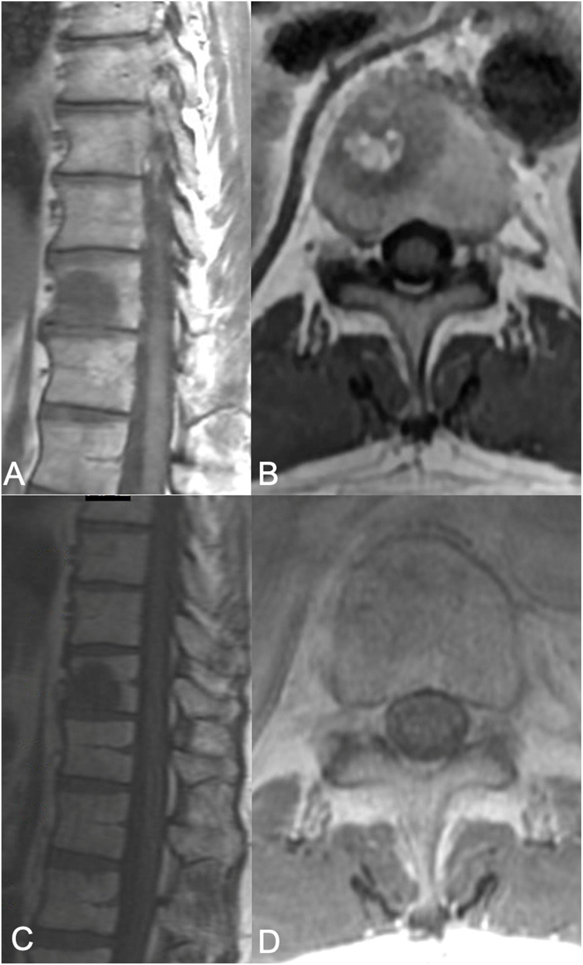 The NOMS approach to metastatic tumors: Integrating new technologies to ...