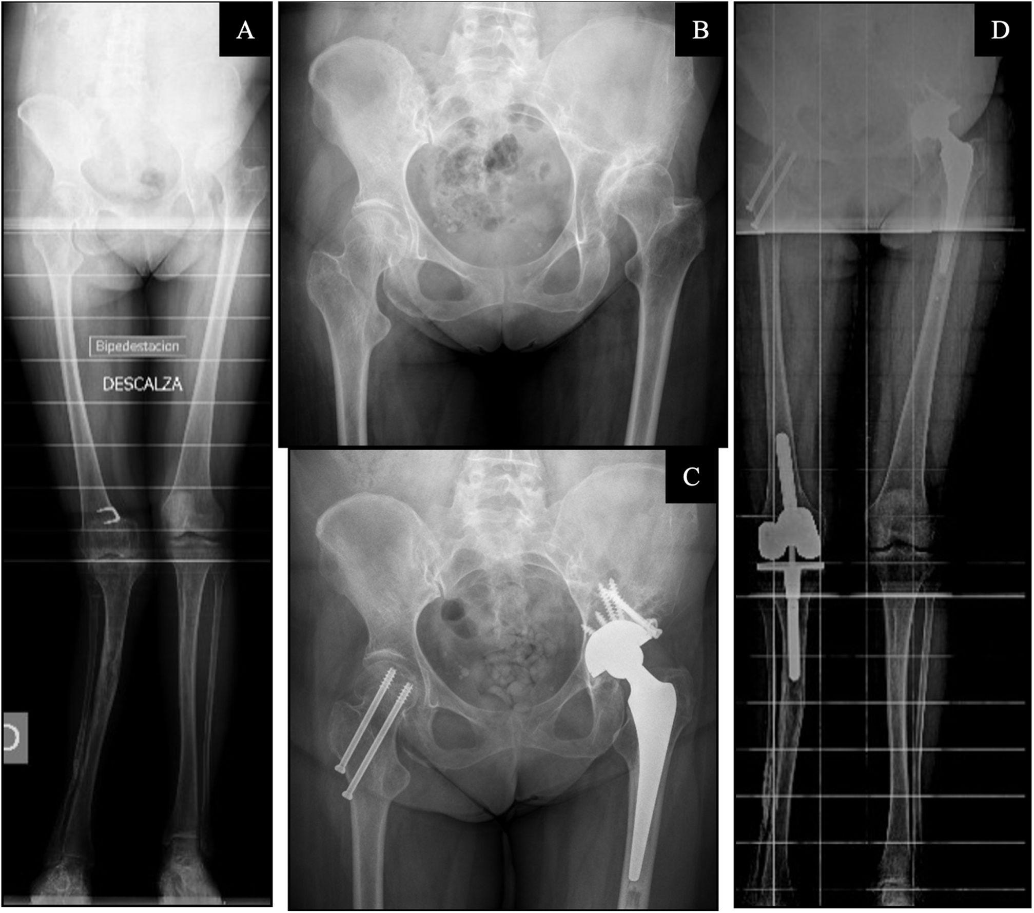 [Translated article] Primary total hip arthroplasty in patients with ...