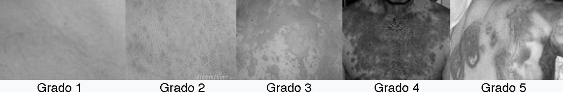 Retratamiento con lamotrigina después de reacción cutánea de rash ...