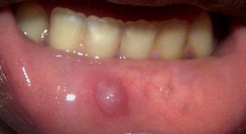 Tumoración en labio inferior: mucocele | Medicina General y de Familia ...