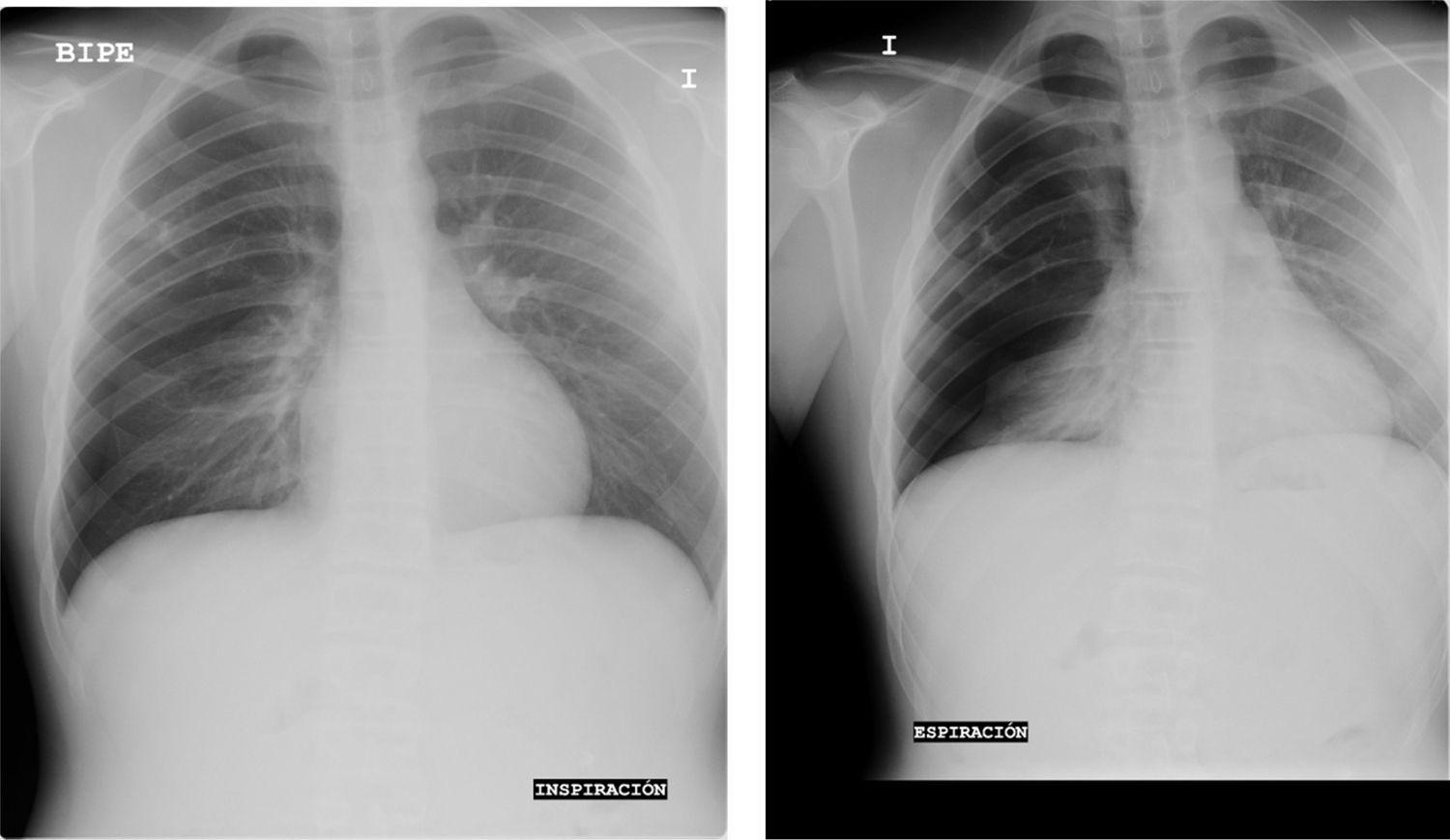 Neumotórax espontáneo | Medicina General y de Familia (edición digital)