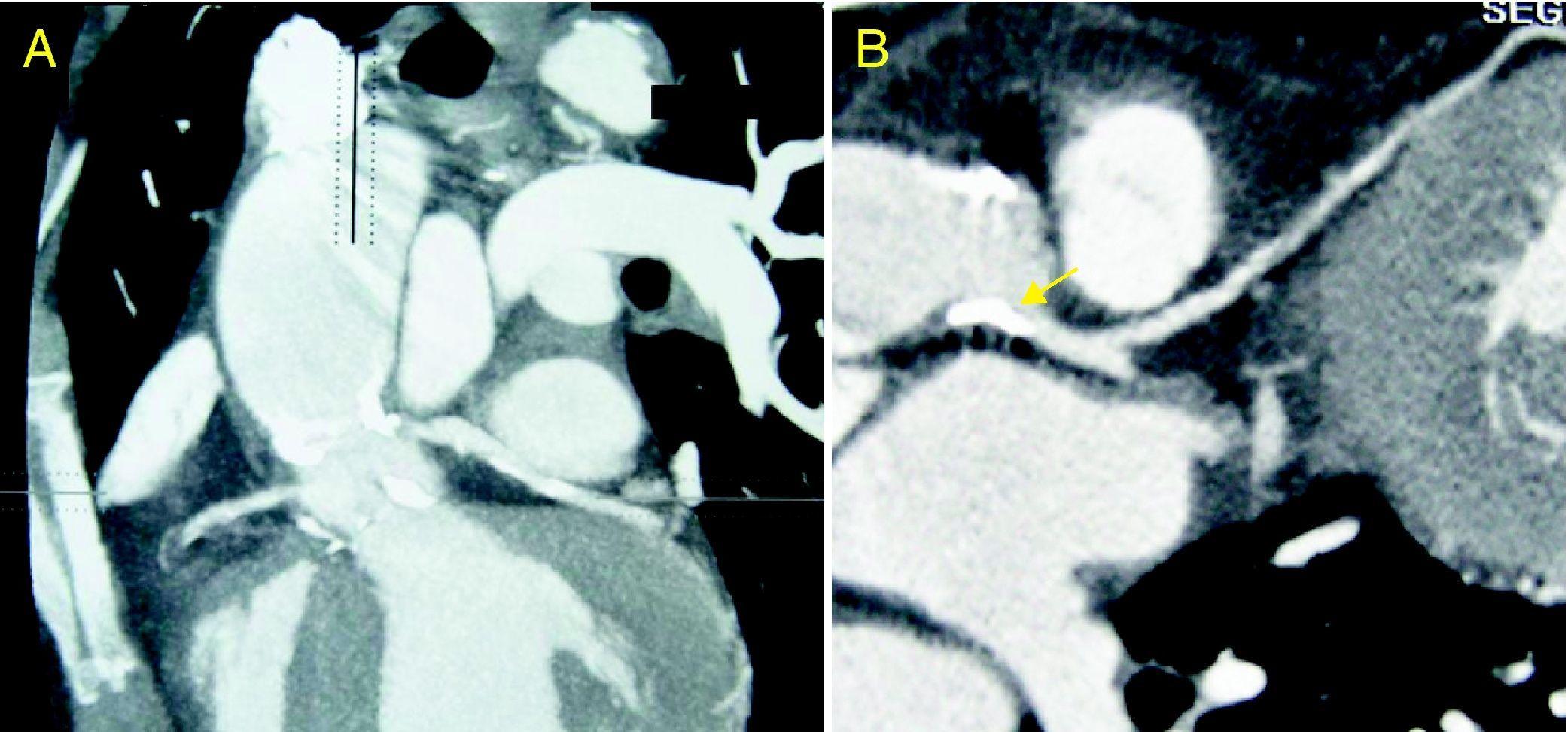 HDL-C bajo: más allá de la aterosclerosis | Cardiocore