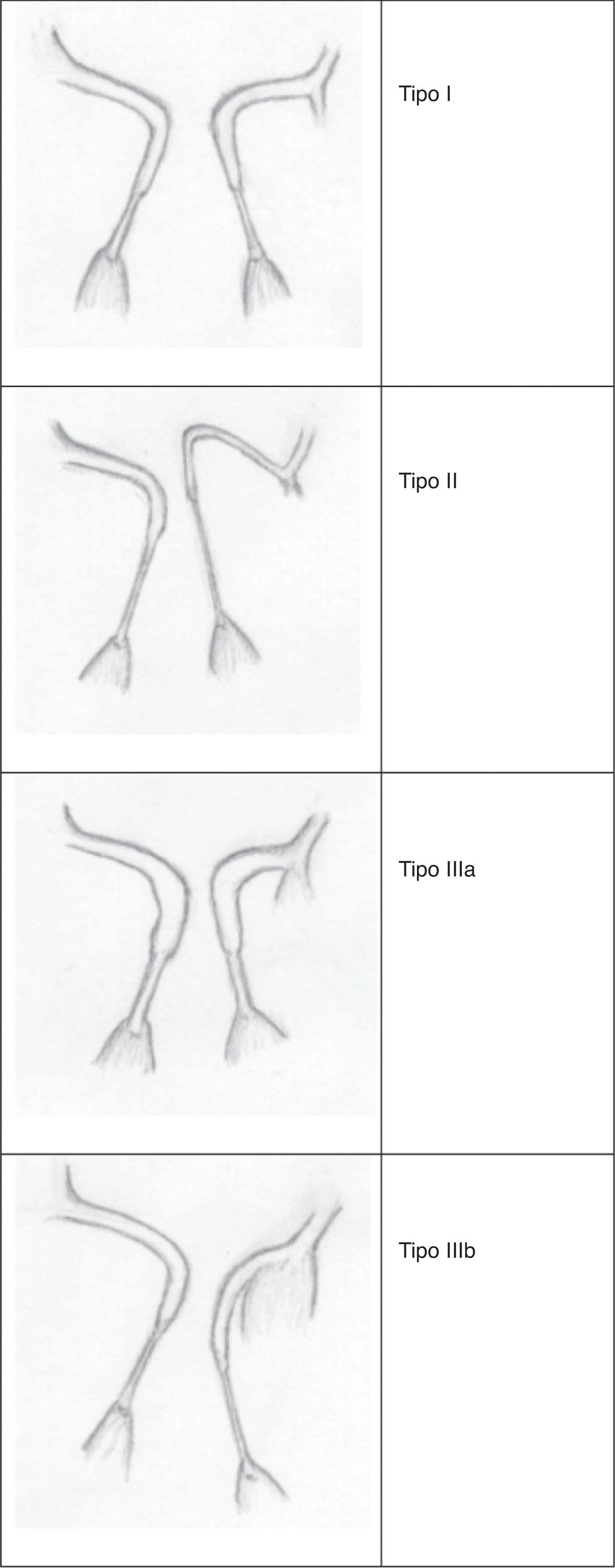 Reparación quirúrgica de la insuficiencia mitral | Cardiocore