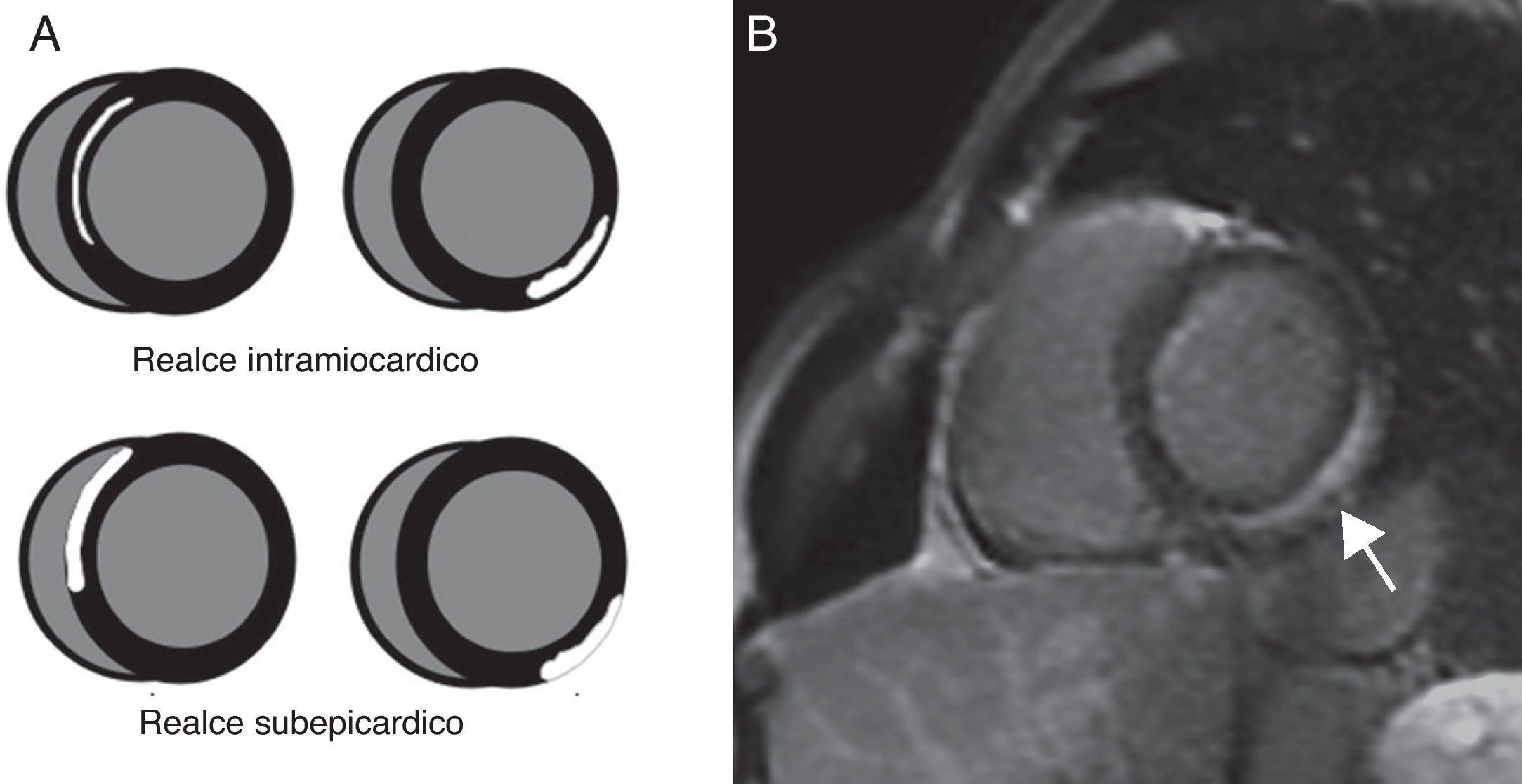 Diagnóstico de la miocarditis. Papel de las técnicas de imagen | Cardiocore