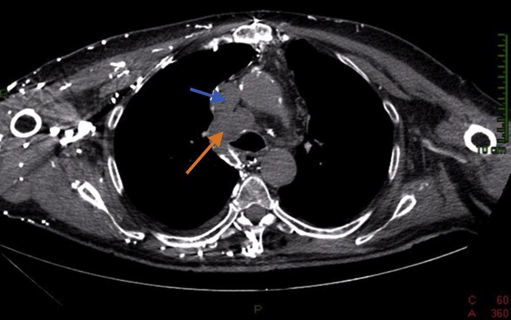Síndrome de la vena cava superior y masa en la aurícula derecha ...