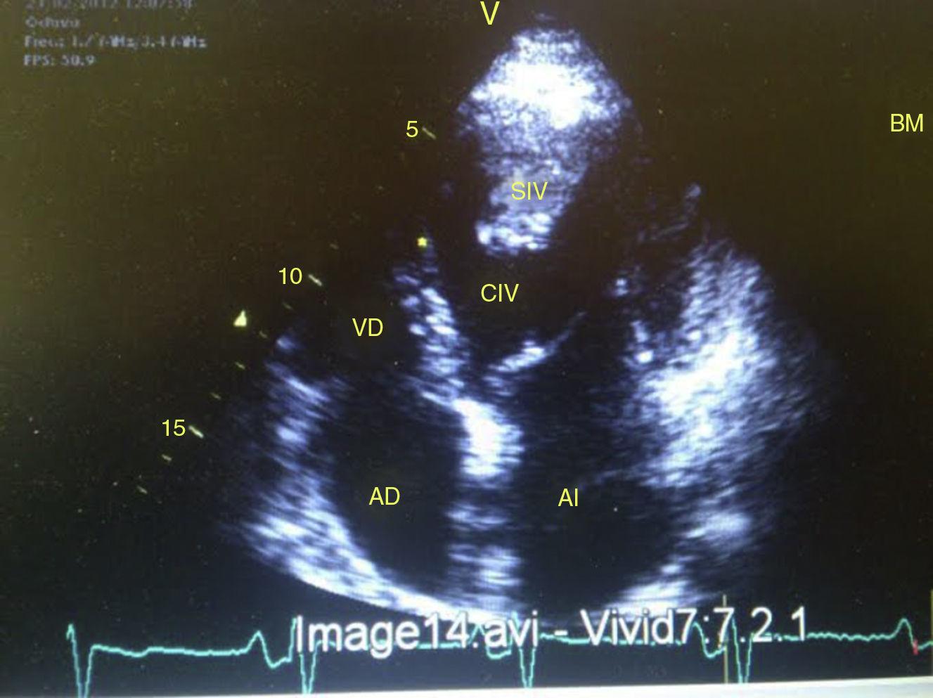 Comunicación interventricular muscular congénita resuelta versus ...