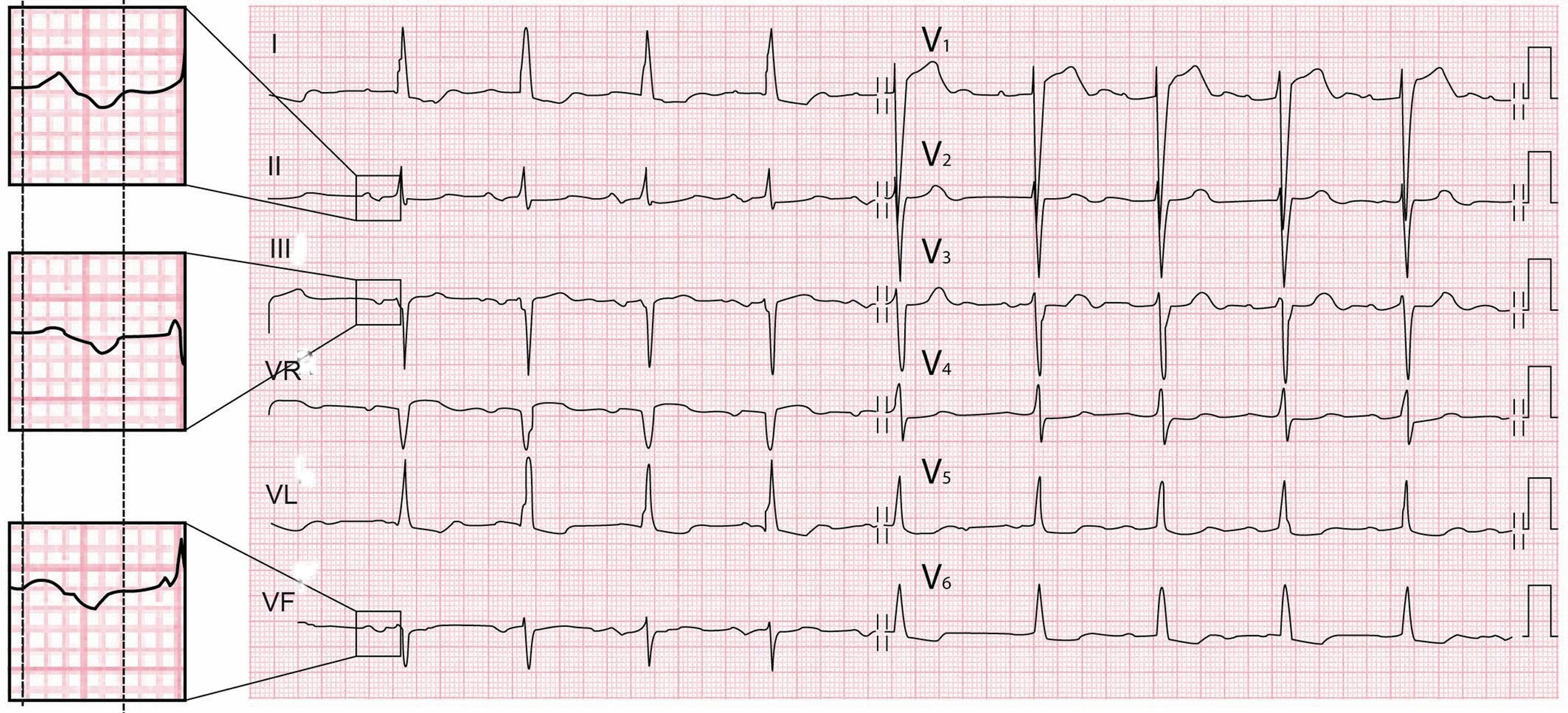 La onda P normal y patológica | Cardiocore