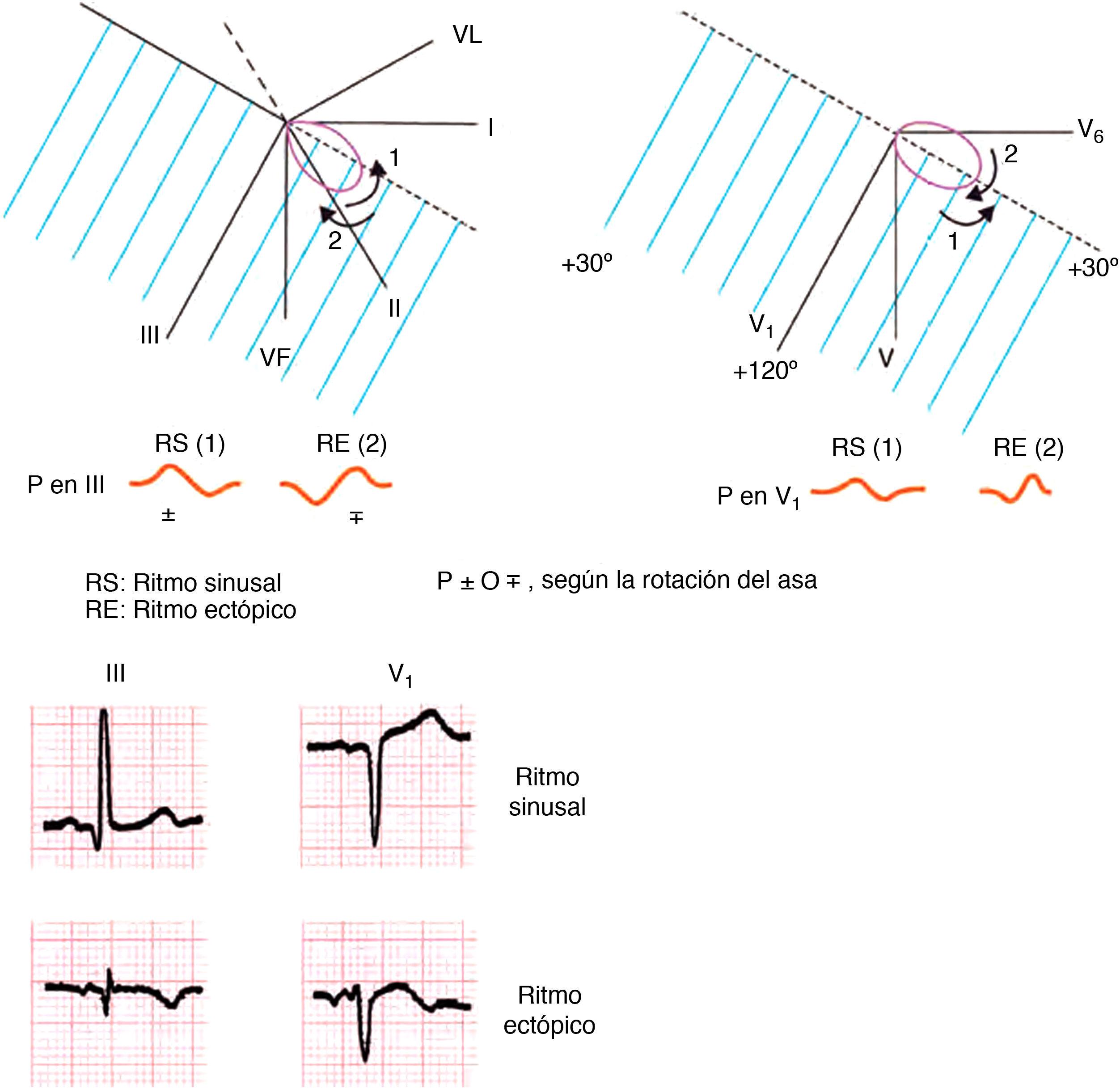 La onda P normal y patológica | Cardiocore
