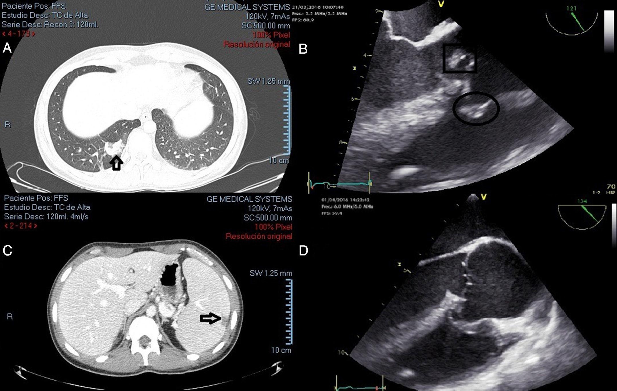 Endocarditis infecciosa subaguda en paciente con comunicación ...
