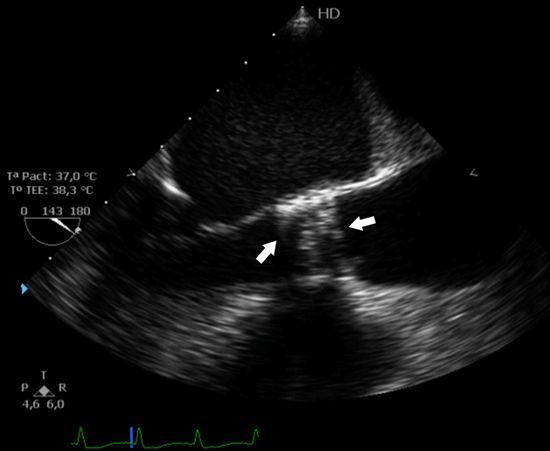 Endocarditis sobre prótesis aórtica percutánea (TAVI) | Cardiocore