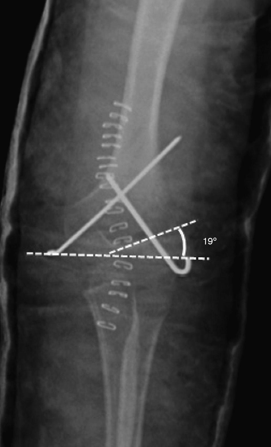 Open reduction and internal fixation of pediatric humeral supracondylar ...