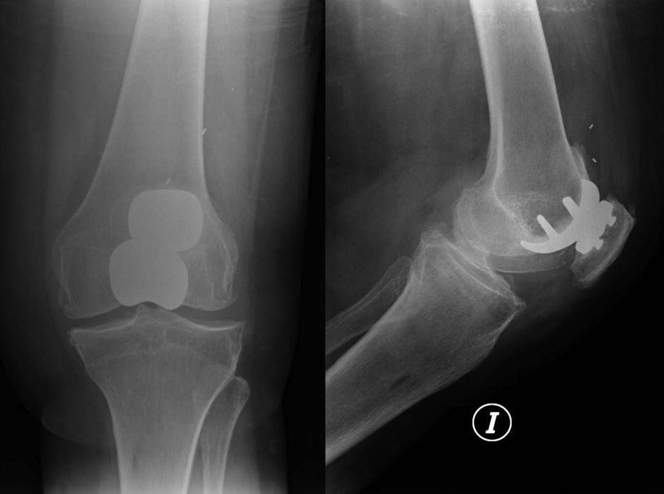 Dislocation of the polyethylene in a patellofemoral replacement with a ...
